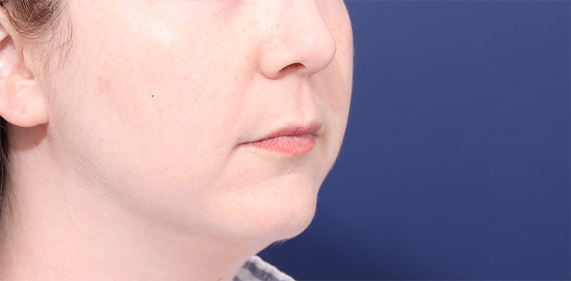 Buccal Fat Removal New Orleans | Cheek Fat Removal New Orleans