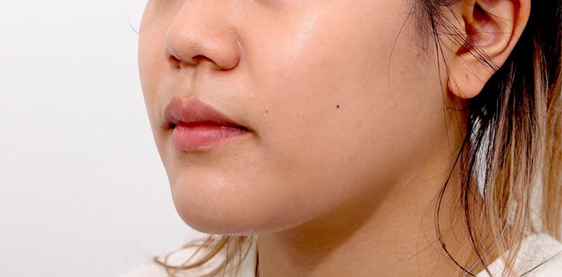 Buccal Fat Removal New Orleans | Cheek Fat Removal New Orleans